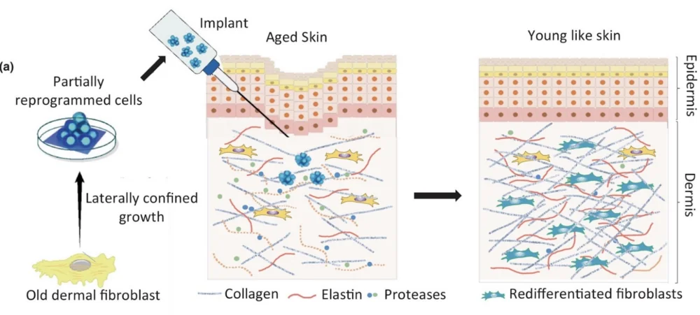 Reprogrammed fibroblasts for skin rejuvenation | Lifespan.io